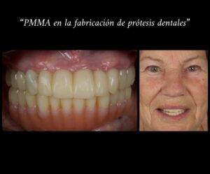 El Polimetilmetacrilato (PMMA) en la Fabricación de Prótesis Dentales ...