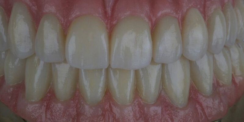 La Importancia del Ajuste Oclusal en Prótesis Dentales – Dental López